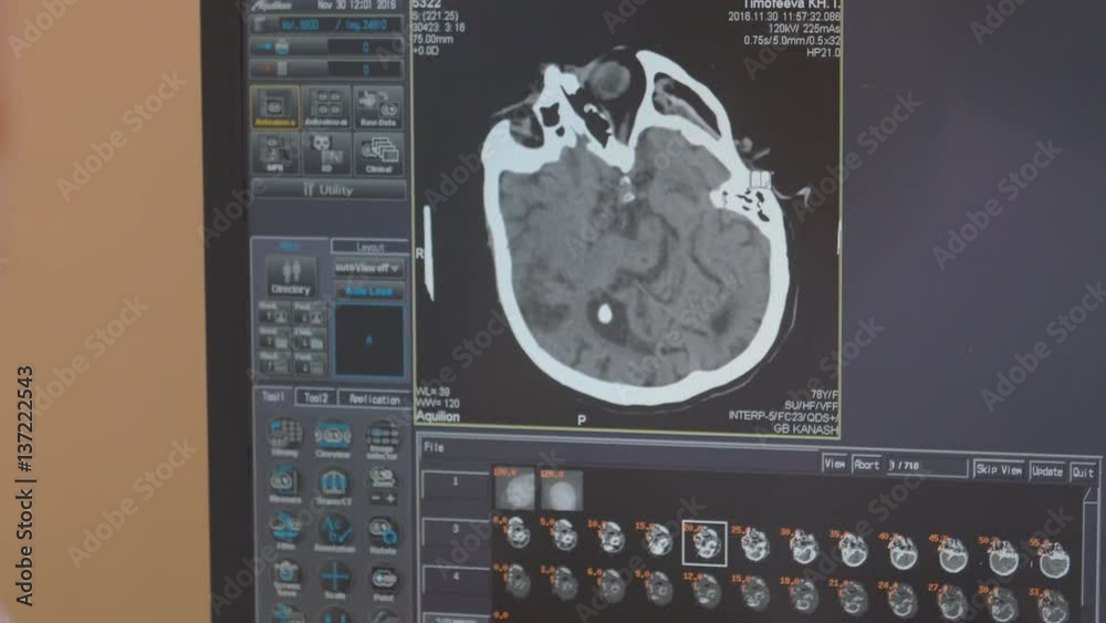 Doctor examines a head MRI scan on a computer screen. Dolly shot. 4K ...