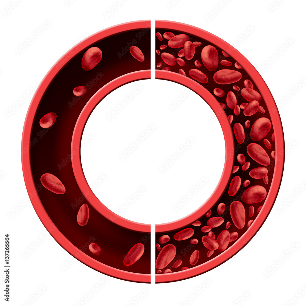 Anemia Anaemia Concept Diagram Stock Illustration | Adobe Stock
