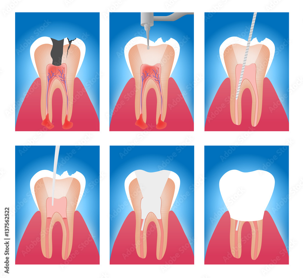 infographic stages of root canal treatment vector Stock Vector | Adobe ...