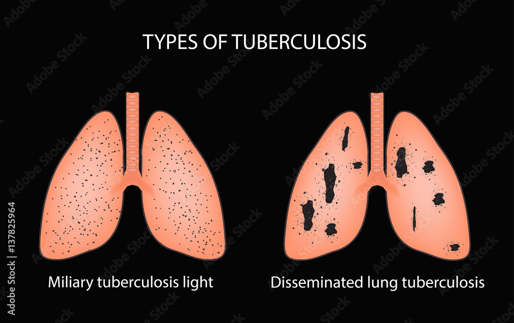 Types of tuberculosis. Miliary and disseminated pulmonary tuberculosis ...