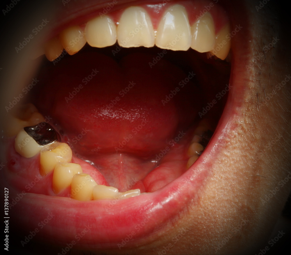 The wound and bleeding at gum in oral cavity scene represent oral care ...