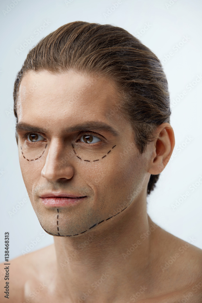 Plastic Surgery. Portrait Handsome Man With Lines On Face Skin 스톡 사진 ...