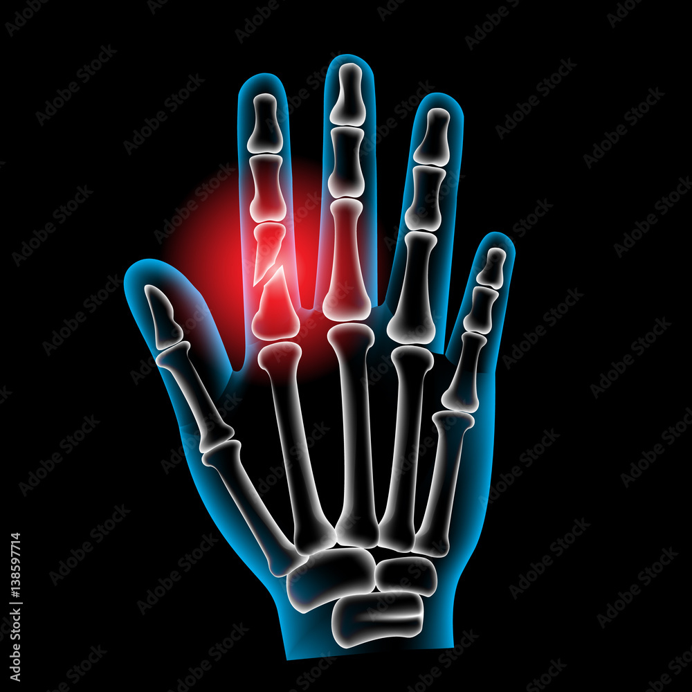 Finger bone, pain, x ray, Broken finger Stock Vector | Adobe Stock