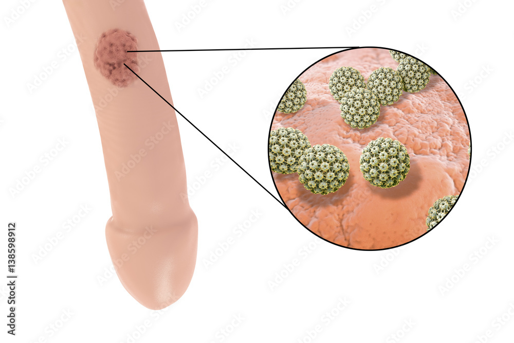 Common locations of genital warts, Human papillomavirus HPV lesions in men, and close-up view of ...