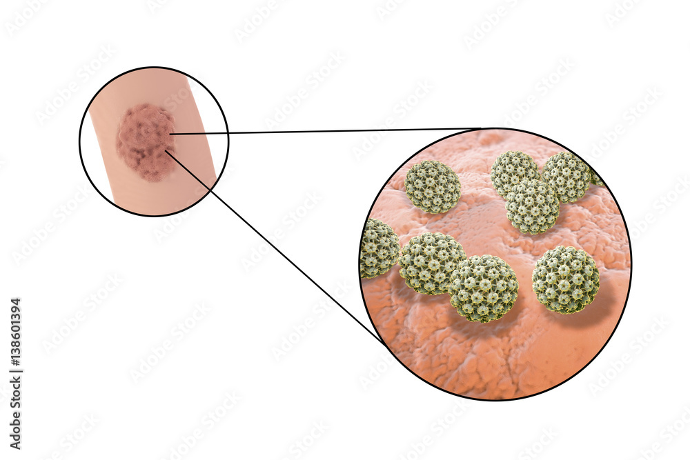 Hpv Men Hpv Men