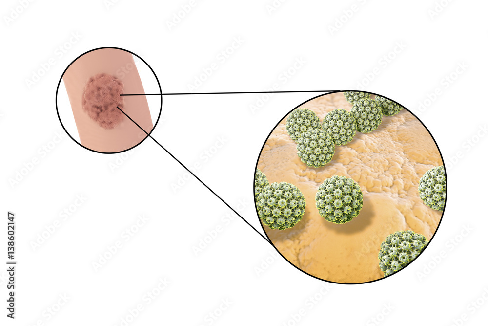 Human papillomavirus HPV lesions in men, genital warts, and close-up ...