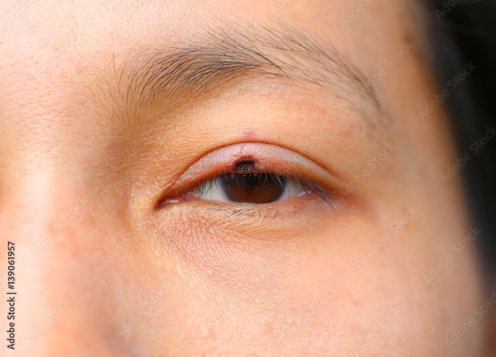 The wound medicine at eyelid, After removal fleck or birthmark by laser ...
