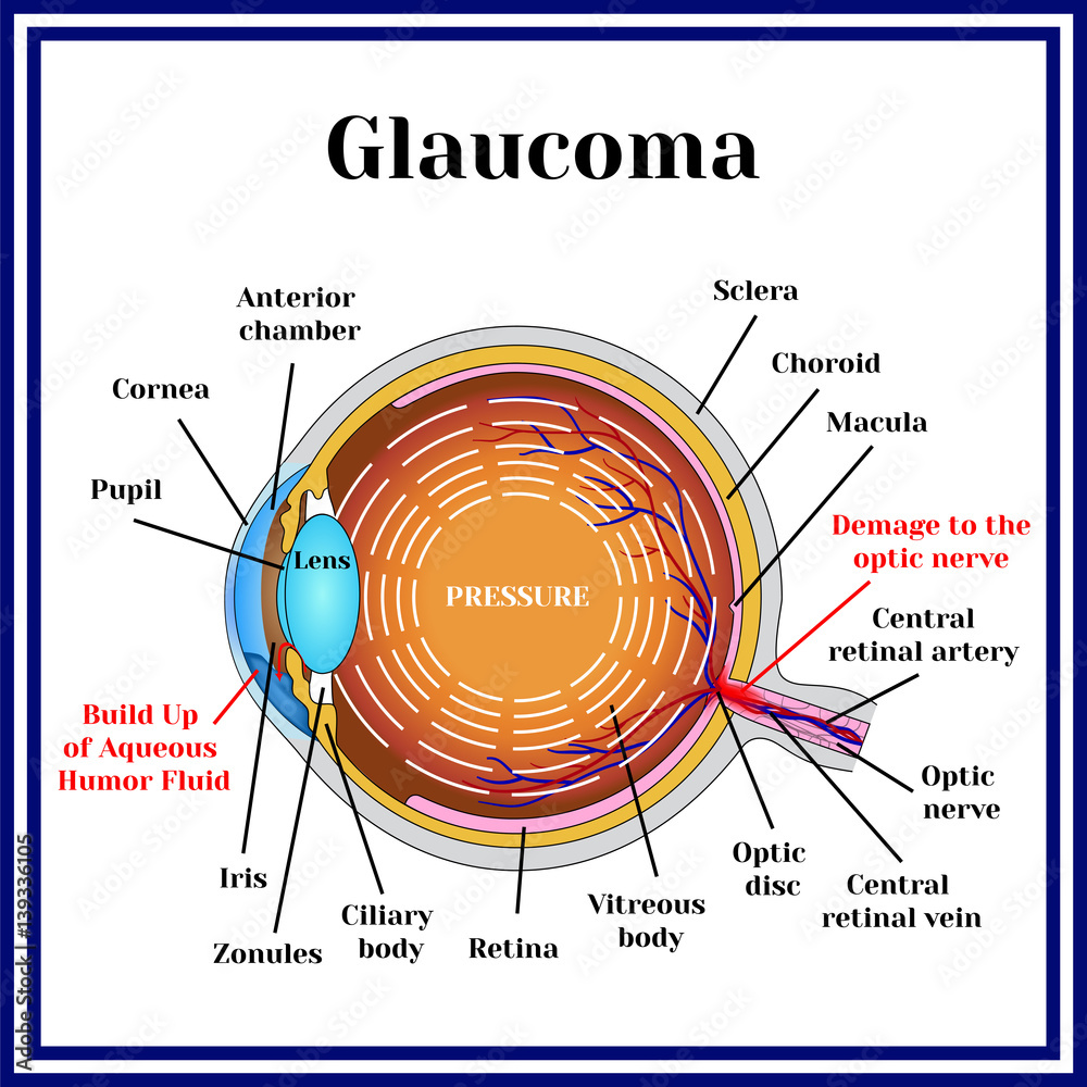 Normal vision. Glaucoma. Chronic eye pathology. Stock Vector | Adobe Stock