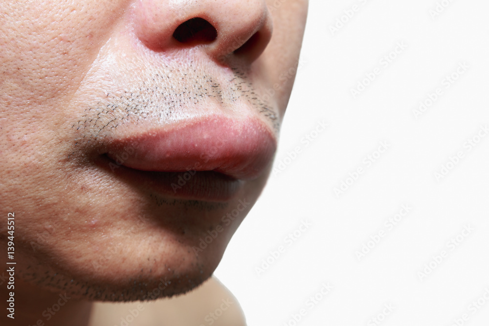 The skin around the mouth caused by an allergic reaction Stock Photo ...