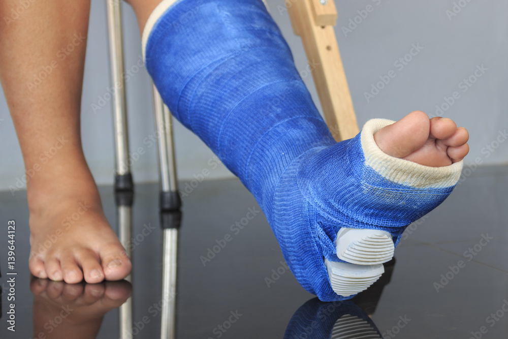 broken leg in a plaster cast with soft-focus in the background. over ...