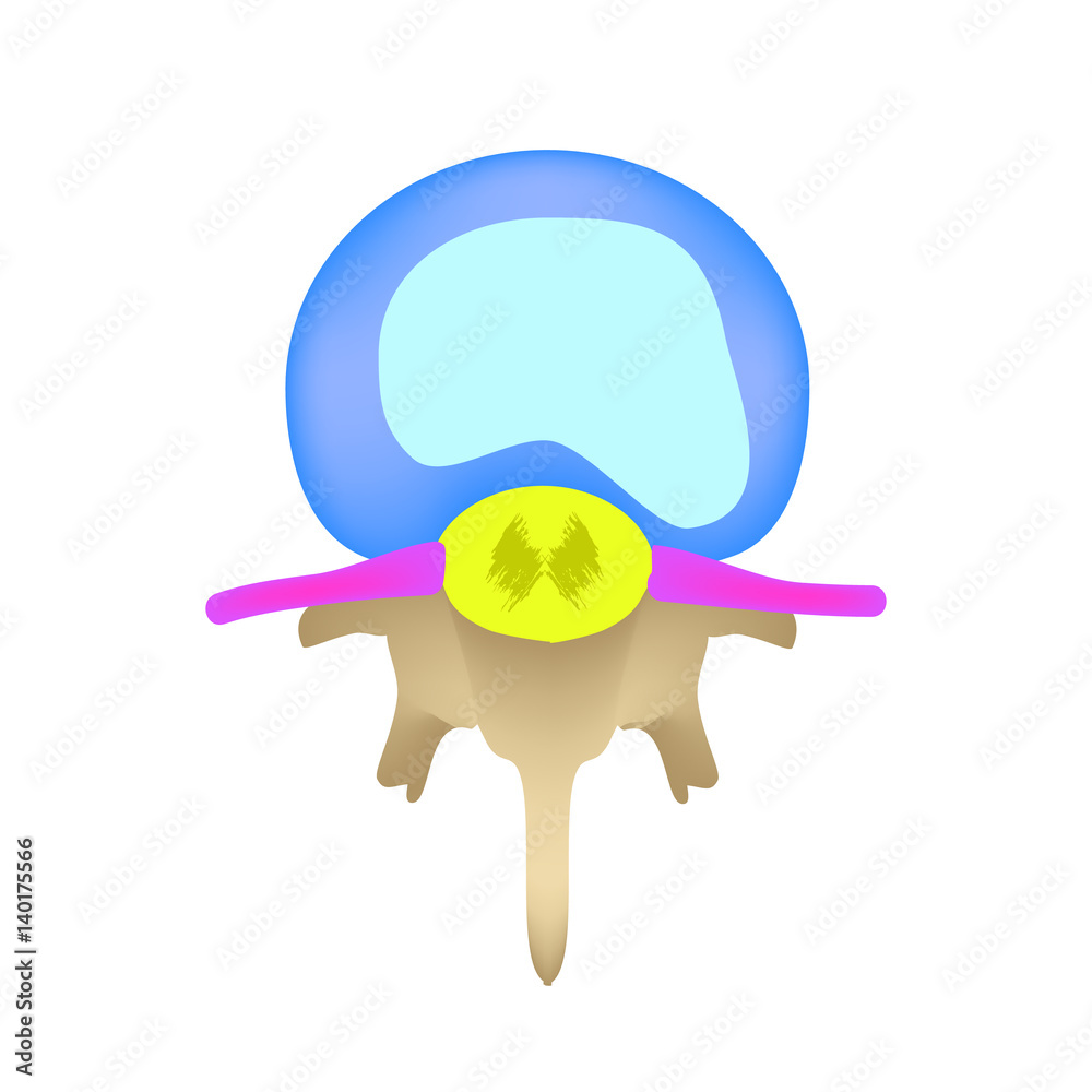 Disc protrusion. Top view. Spine. Infographics. Vector illustration on ...