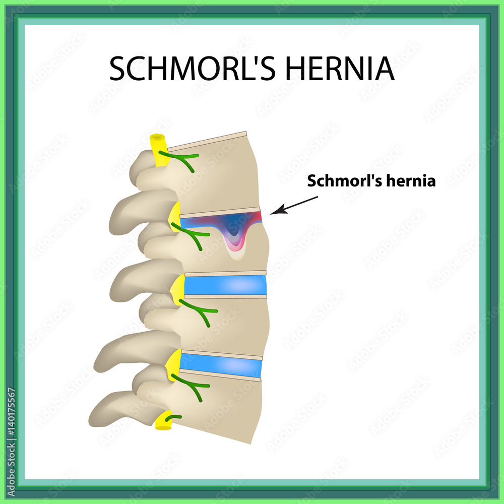 Hernia Schmorl. Intervertebral disc. Side view. Spine. Infographics ...