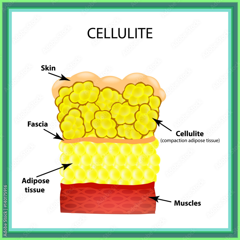 Cellulite. The anatomical structure of the adipose tissue. Infographics ...