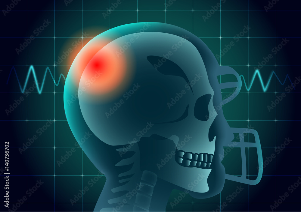 Skull of American football athlete have a red signal on physical ...
