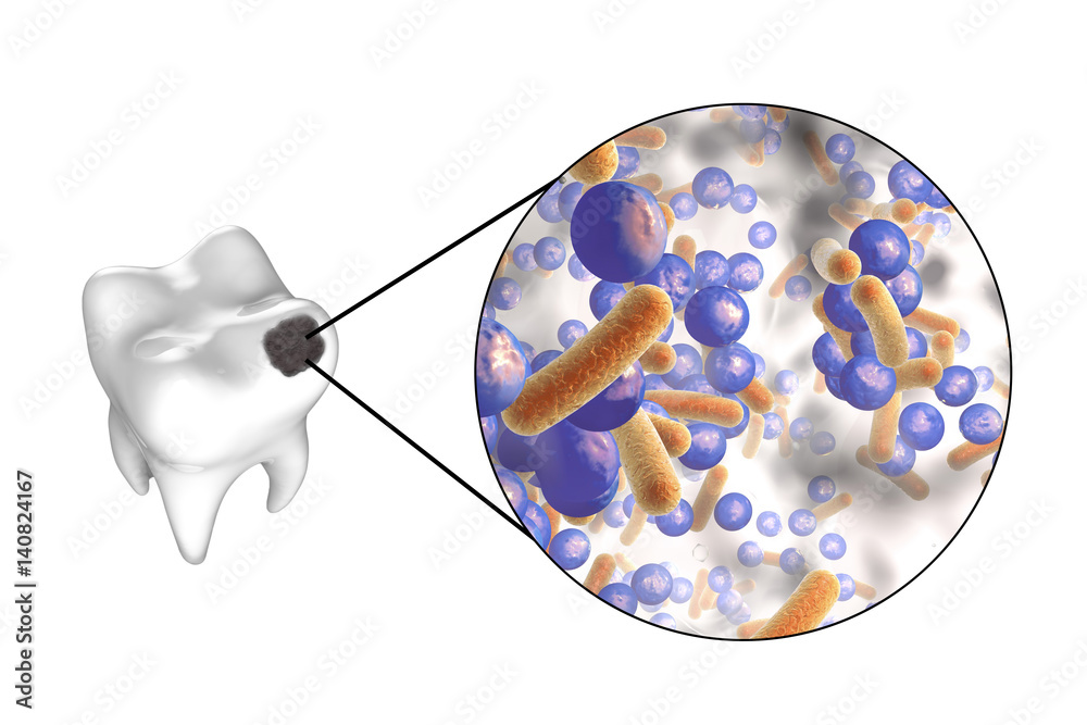Tooth with dental caries and close-up view of microbes which cause ...