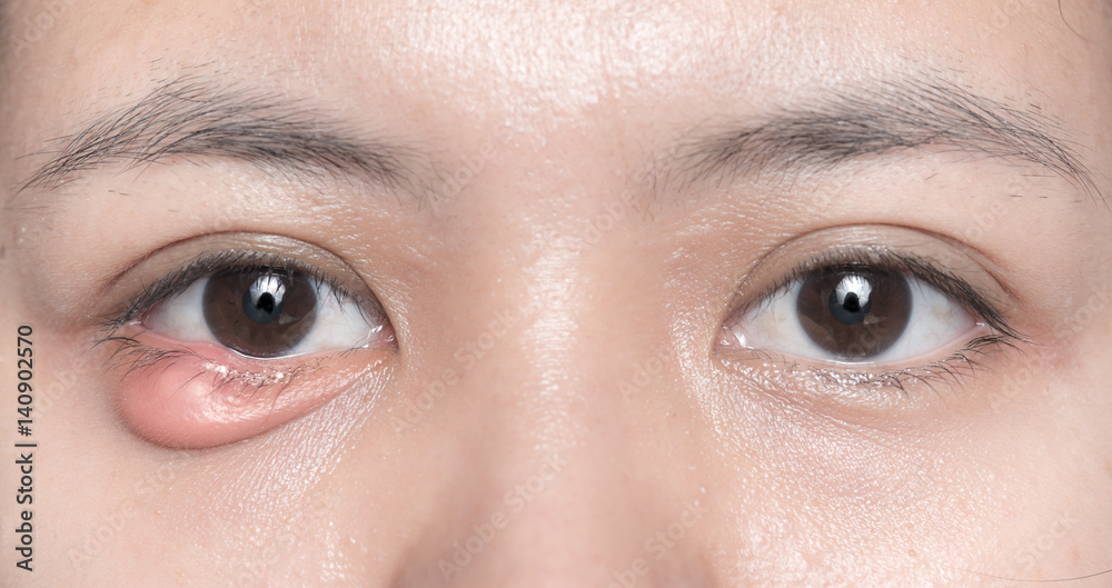Close up of eyelid abscess (stye, hordeolum) Stock Photo | Adobe Stock
