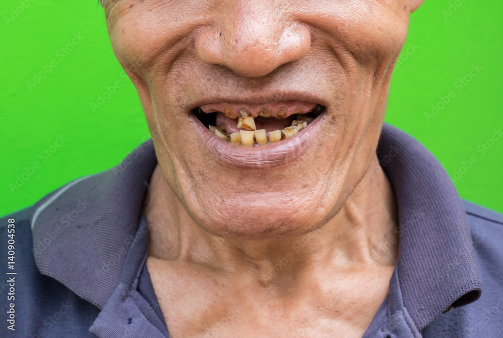 The Ugliest Teeth In The World