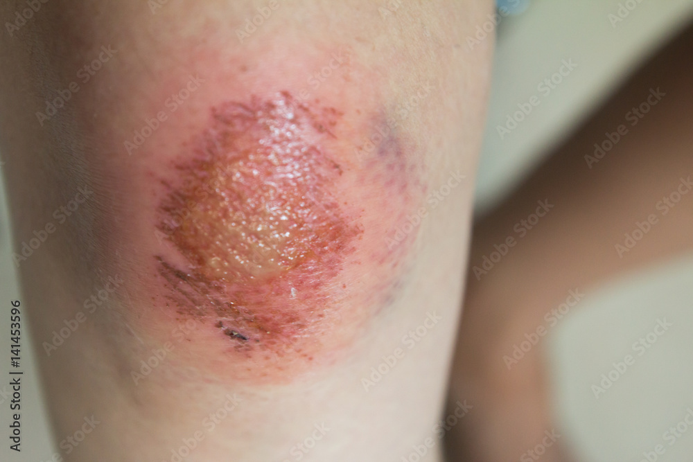 Fresh wound with lymph and blood on asian female knee background Stock ...