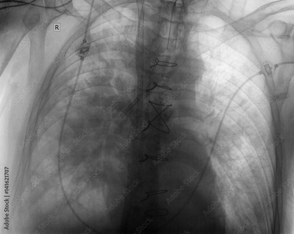X-ray image of a patient with pneumonia Stock Photo | Adobe Stock