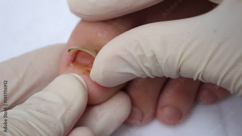 Vidéo Stock The injured nail removed by a small operation done under ...