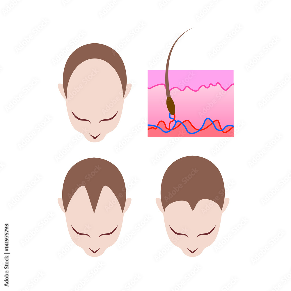 Male Hair Loss Stages Set Man Before And After Hair Treatment And Hair Transplantation Male