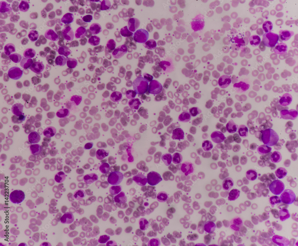 Leukemia blood cells medical science background concept. Stock Photo ...