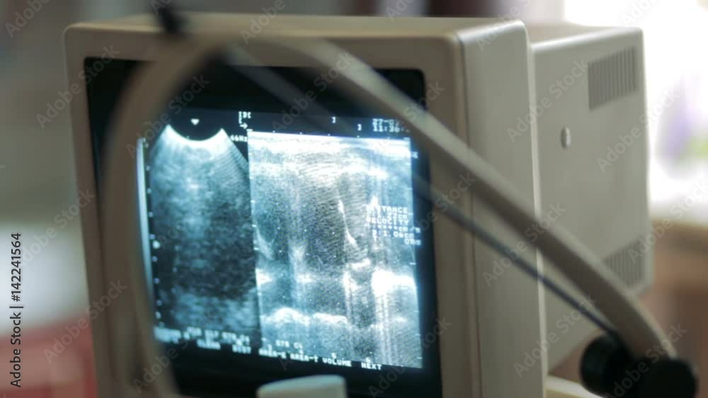 Ultrasound examination of the heart Stock Video | Adobe Stock