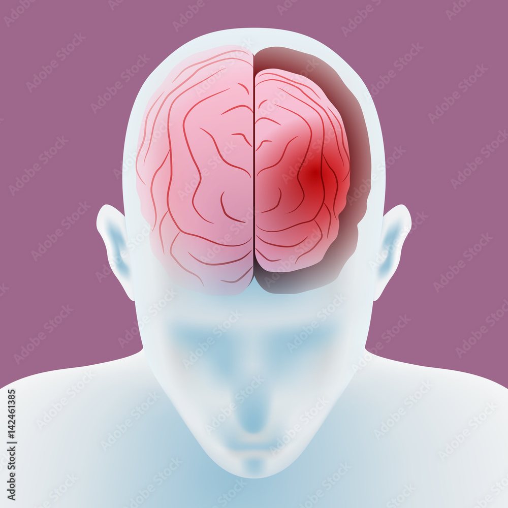 brain atrophy, structure of human brain Stock Vector | Adobe Stock