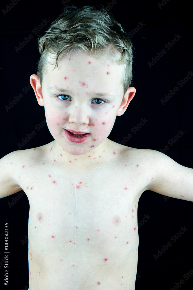 Fotografia do Stock: Caucasian boy with chickenpox infection, rash and ...