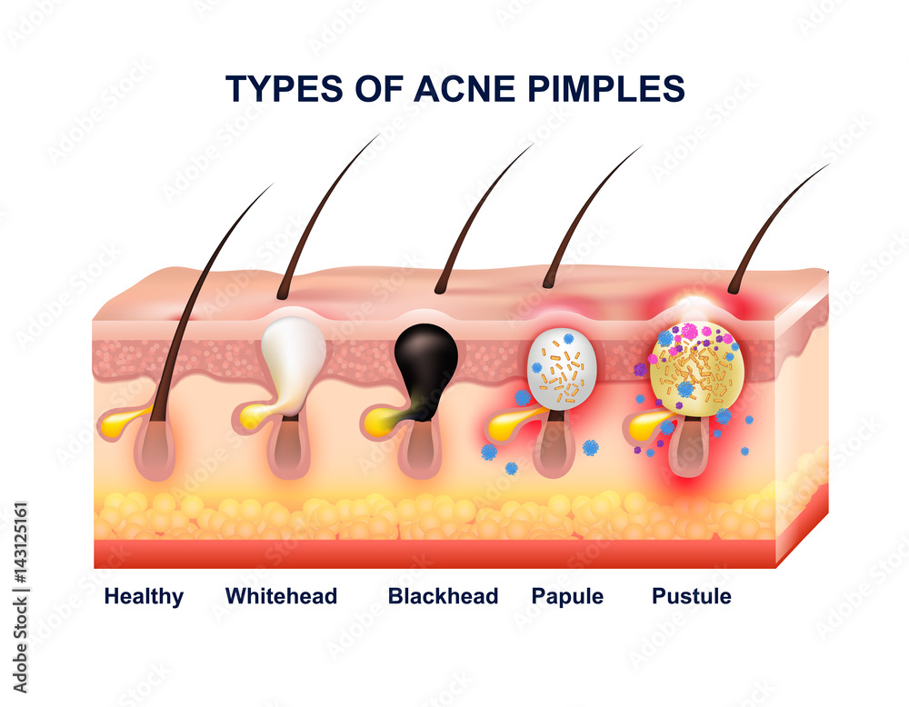 Skin Acne Anatomy Composition Stock Vector | Adobe Stock