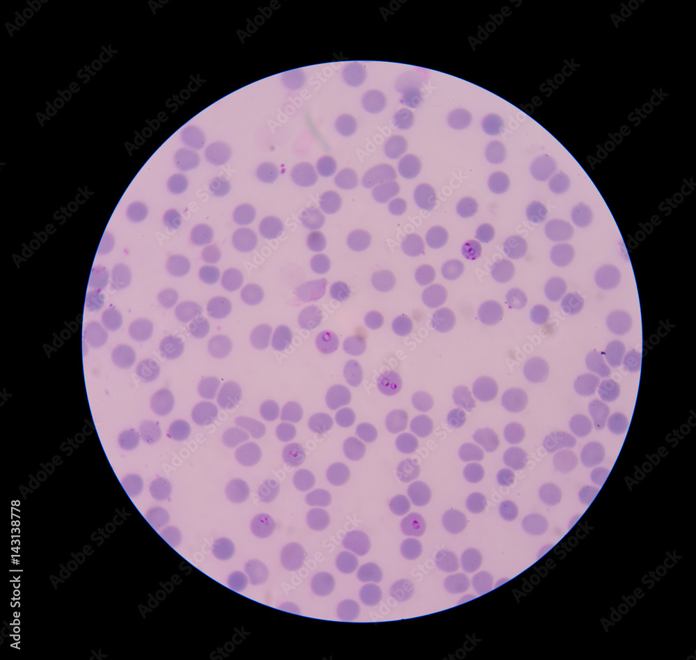 Malaria ring form infection on red blood cells. Stock Photo | Adobe Stock