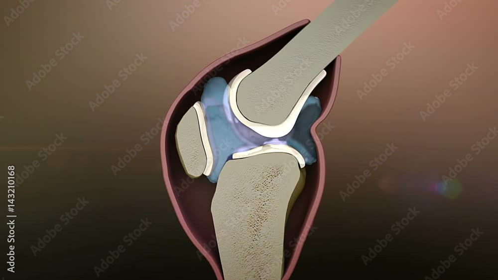 human bone destruction, human joint destruction, 3d rendered knee ...