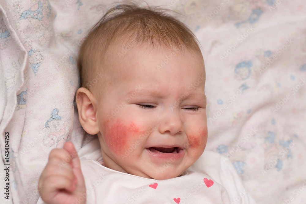 Cute baby with eczema on her face crying in pain Stock Photo | Adobe Stock