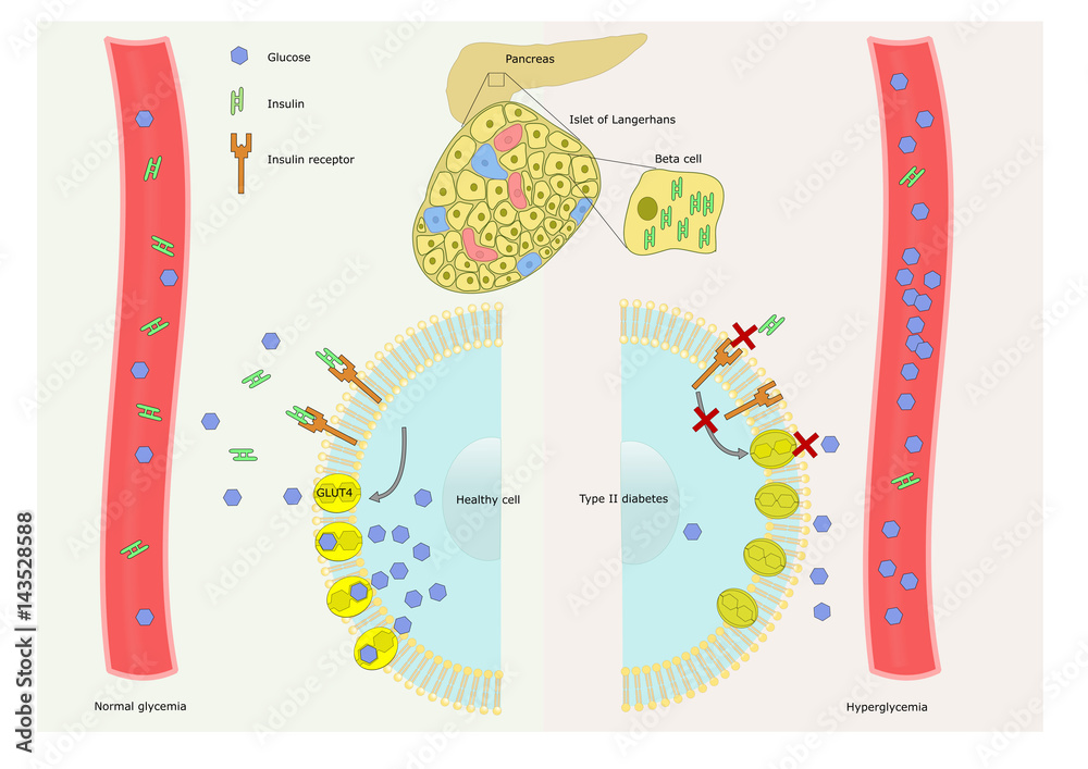 diabetes and mechanism of insulin resistance Stock Vector | Adobe Stock