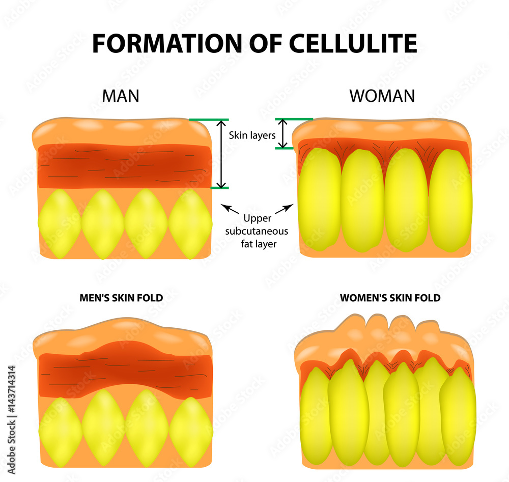 Cellulitis and skin aging in men and women. Infographics. Vector ...