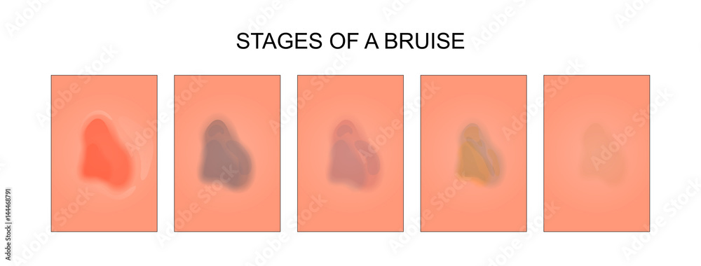 stages of healing of a bruise เวกเตอร์สต็อก | Adobe Stock