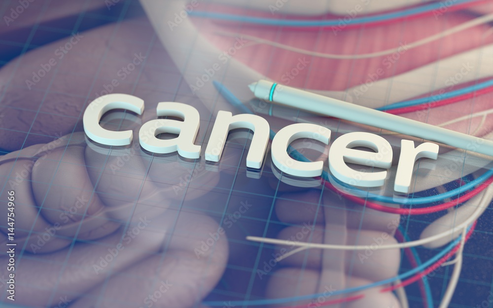 The word "cancer" on a reflective digital surface with anatomical ...