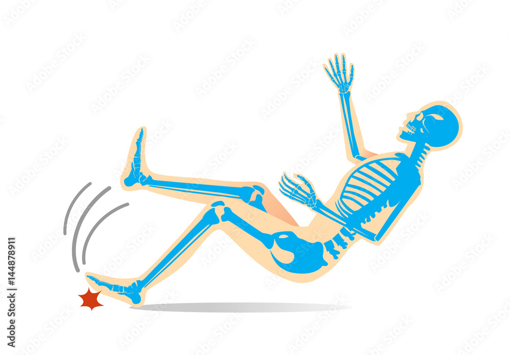 Physical injury from slip accident. Illustration about safety lifestyle ...