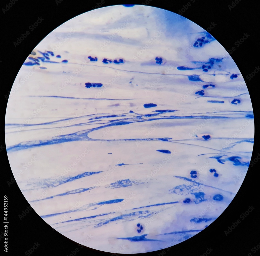 Smear of Acid-Fast bacilli (AFB) stained from sputum specimen, under ...