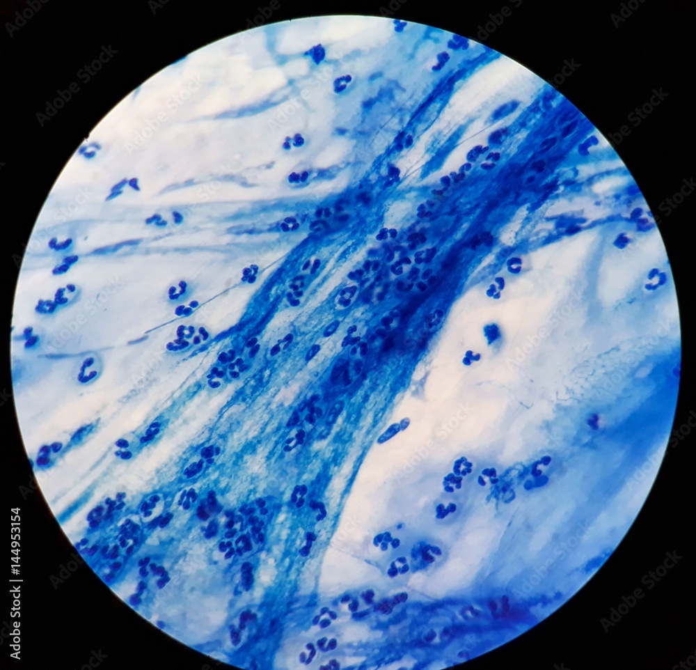 Smear of Acid-Fast bacilli (AFB) stained from sputum specimen, under ...