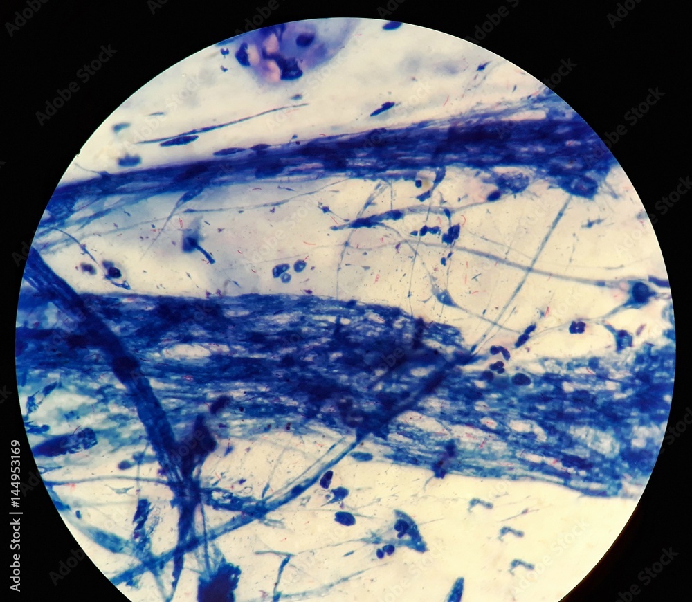Smear of Acid-Fast bacilli (AFB) stained from sputum with positive ...