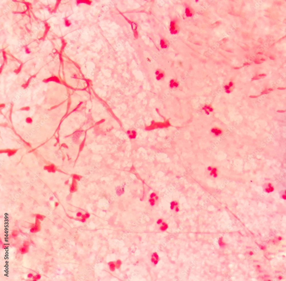 Smear of sputum specimen Gram's stained under 100X light microscope ...