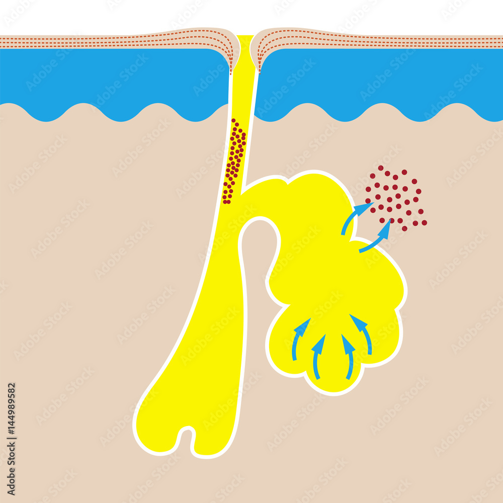 Acne vulgaris or pimple formation process Stock Vector | Adobe Stock