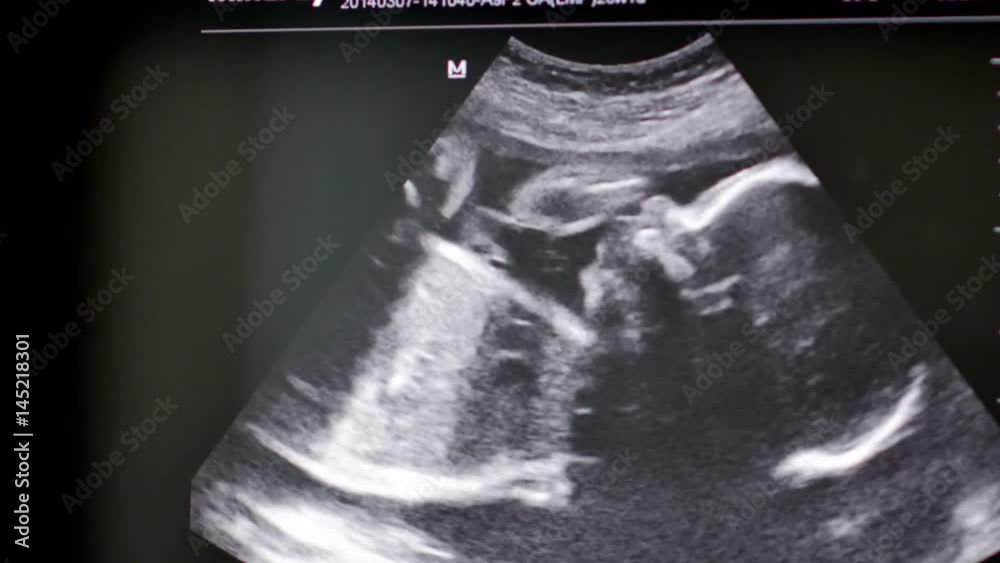 Monitor with medical ultrasound scan of human baby. 4K UltraHD footage ...