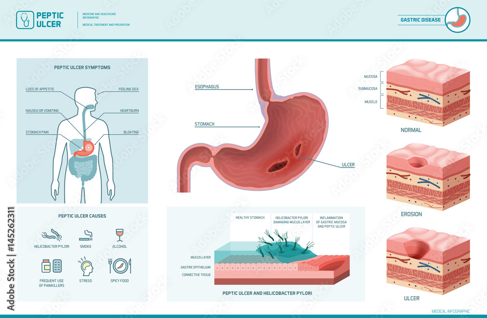 Peptic ulcer and helicobacter pylori infographic Stock Vector | Adobe Stock