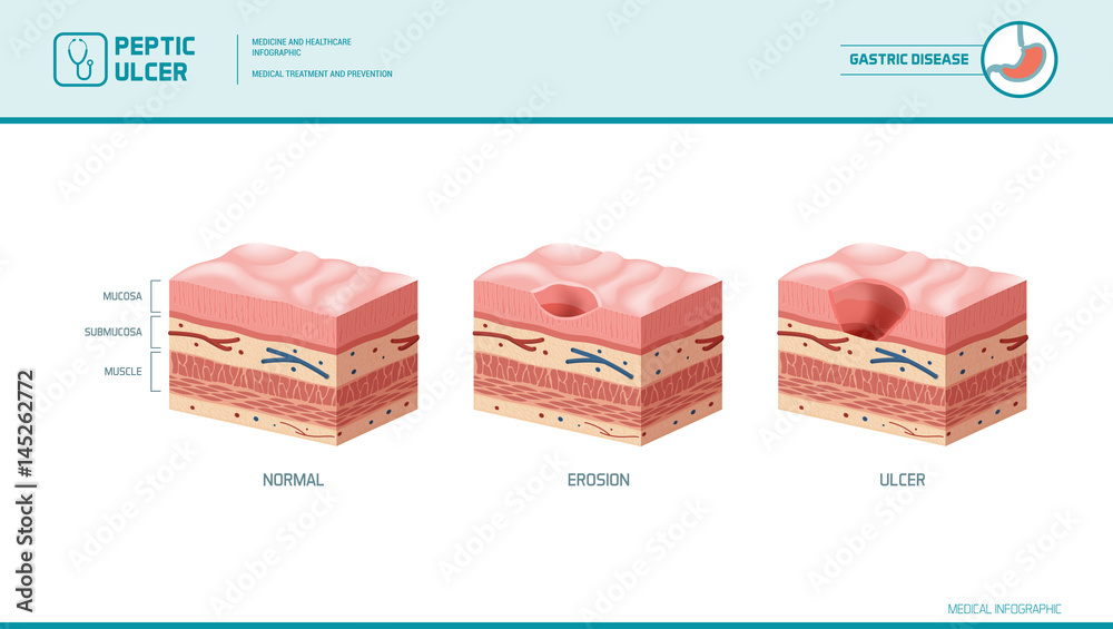Stomach erosion and peptic ulcer Stock Vector | Adobe Stock