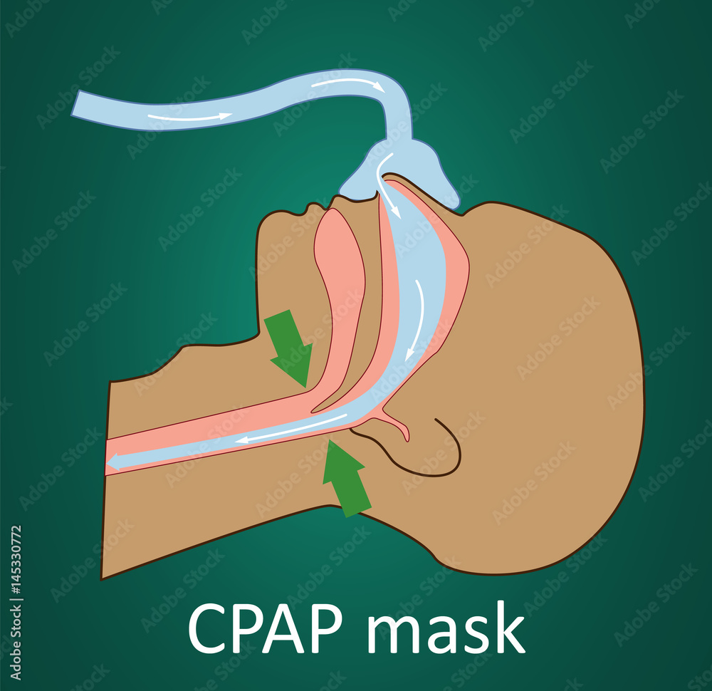 Vector illustration of normal breathing with CPAP mask. Stock Vector ...
