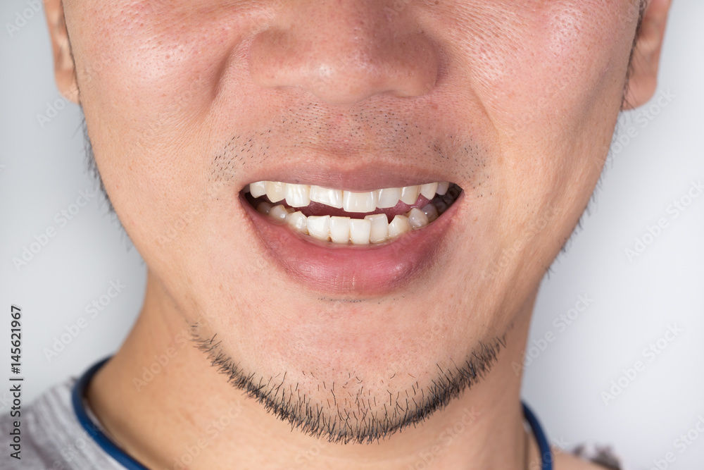 ugly smile dental problem. Teeth Injuries or Teeth Breaking in Male ...