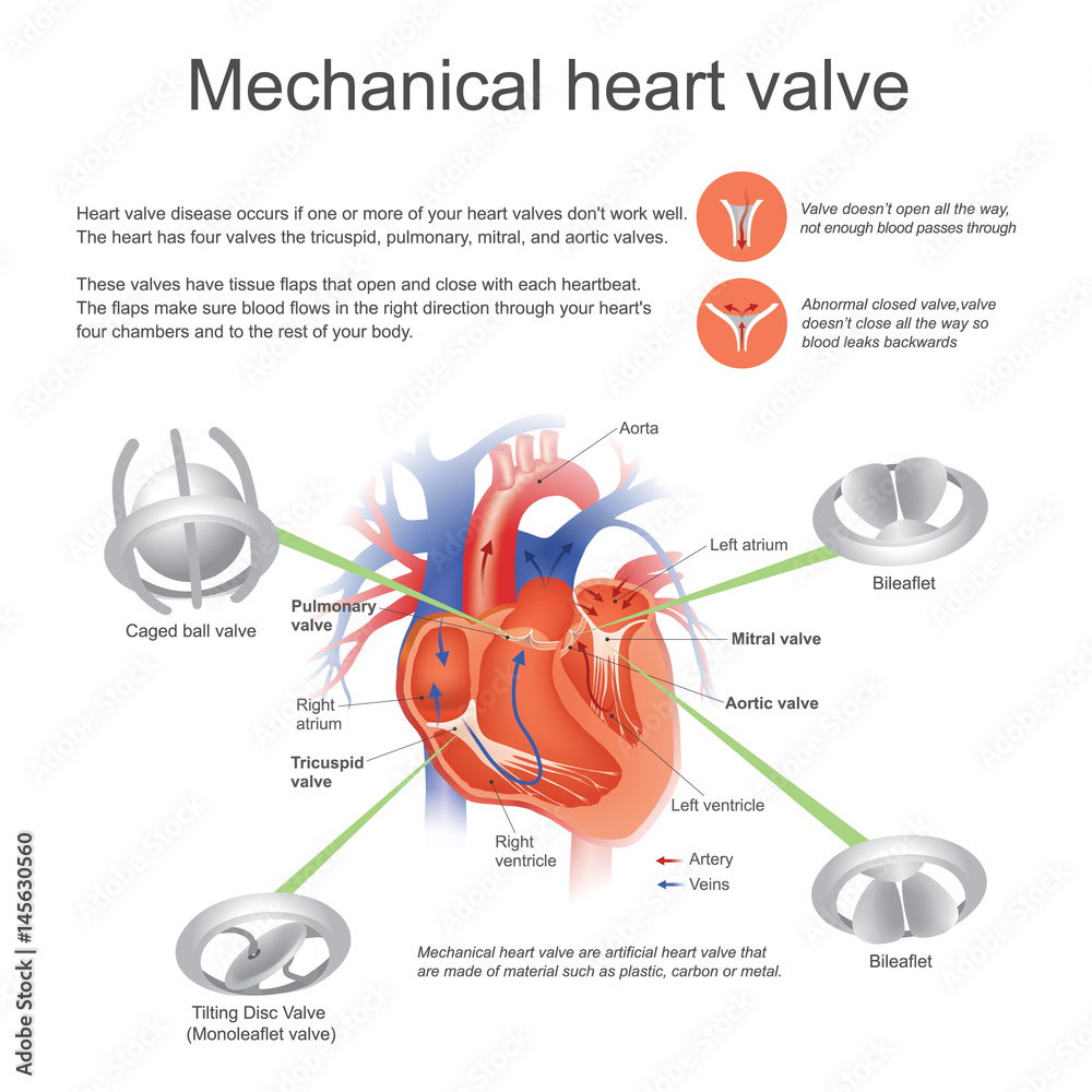 Mechanical Heart Valve