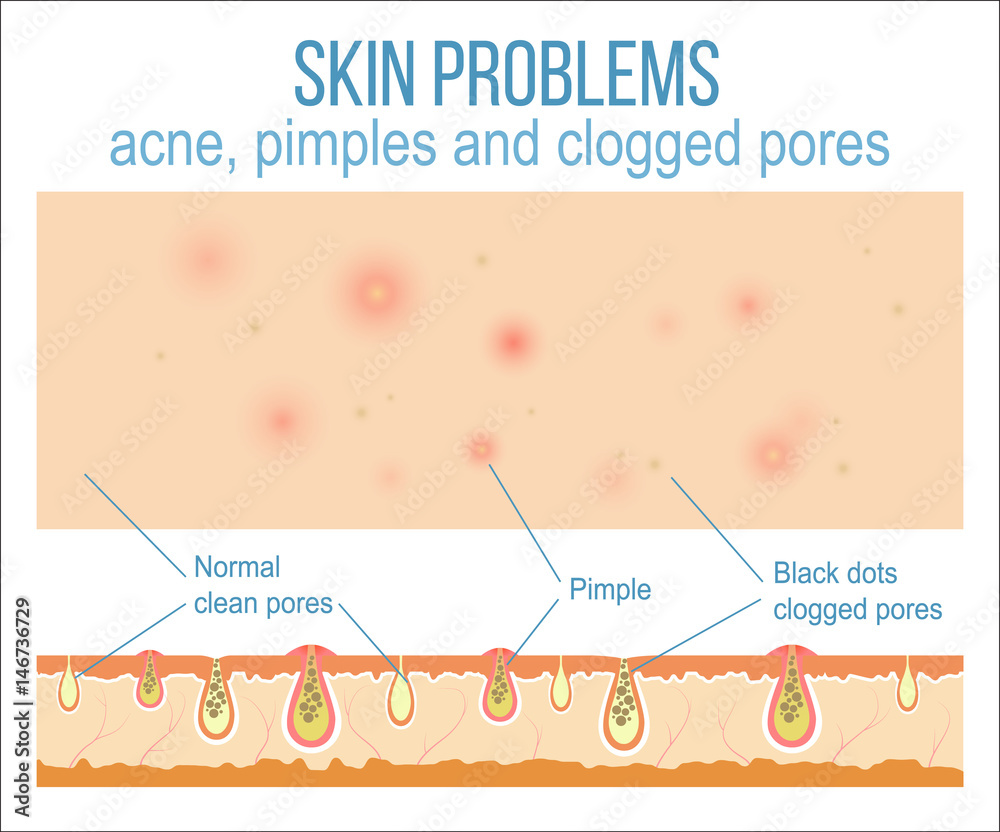 Skin problems such as acne, pimples and clogged pores. Top view of skin ...